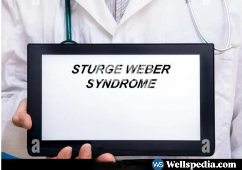 Sturge-Weber Syndrome: Symptoms, Diagnosis & Treatment